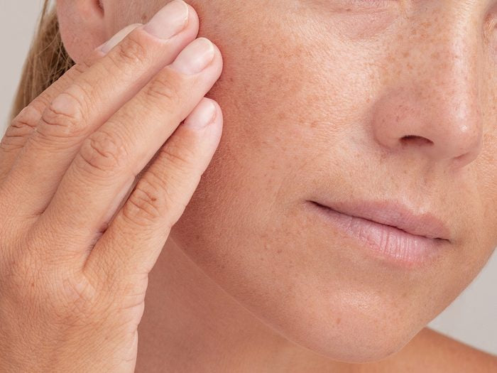 How to Treat Dark Spots, According to a Dermatologist – Kat Mango